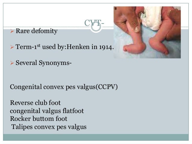 congenital vertical talus by DR.Girish motwani