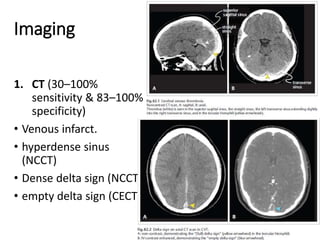 Cerebral Venous thrombosis.pptx