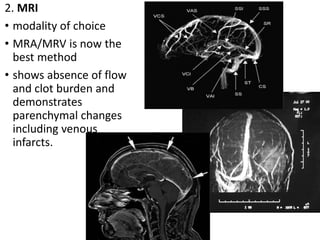 Cerebral Venous thrombosis.pptx