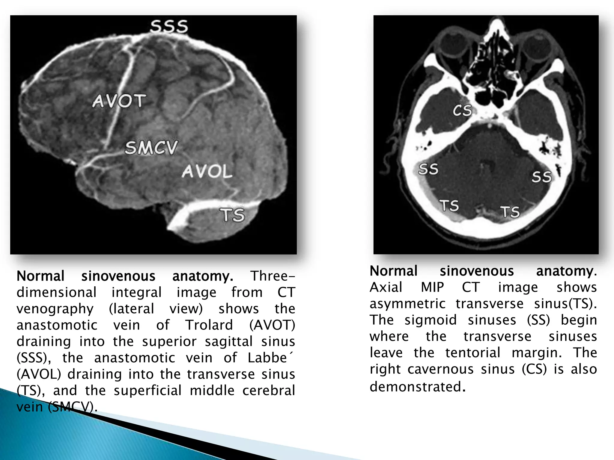 CEREBRAL VENOUS THROMBOSIS | PPTX