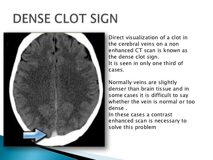 CEREBRAL VENOUS THROMBOSIS