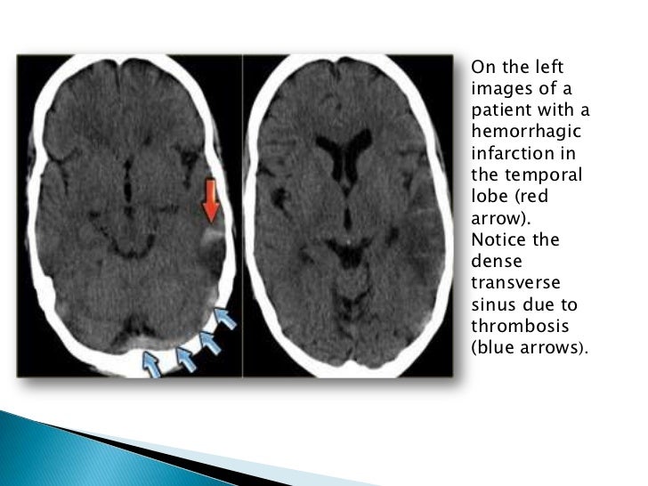 CEREBRAL VENOUS THROMBOSIS