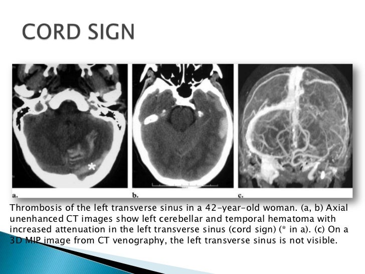 CEREBRAL VENOUS THROMBOSIS