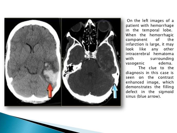 CEREBRAL VENOUS THROMBOSIS