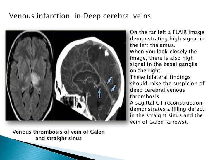 CEREBRAL VENOUS THROMBOSIS
