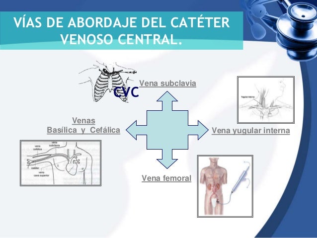 CATÉTER VENOSO CENTRAL