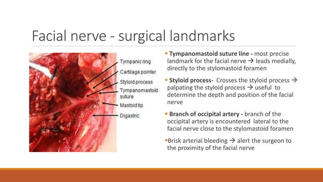 Parotidectomy | PPTX