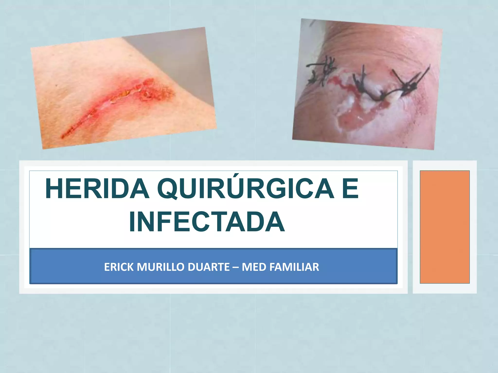 INFECCION HERIDA QUIRURGICA | PPTX
