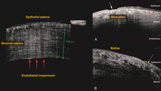 Cxl for the treatment of bullous keratopathy in dogs | PPTX