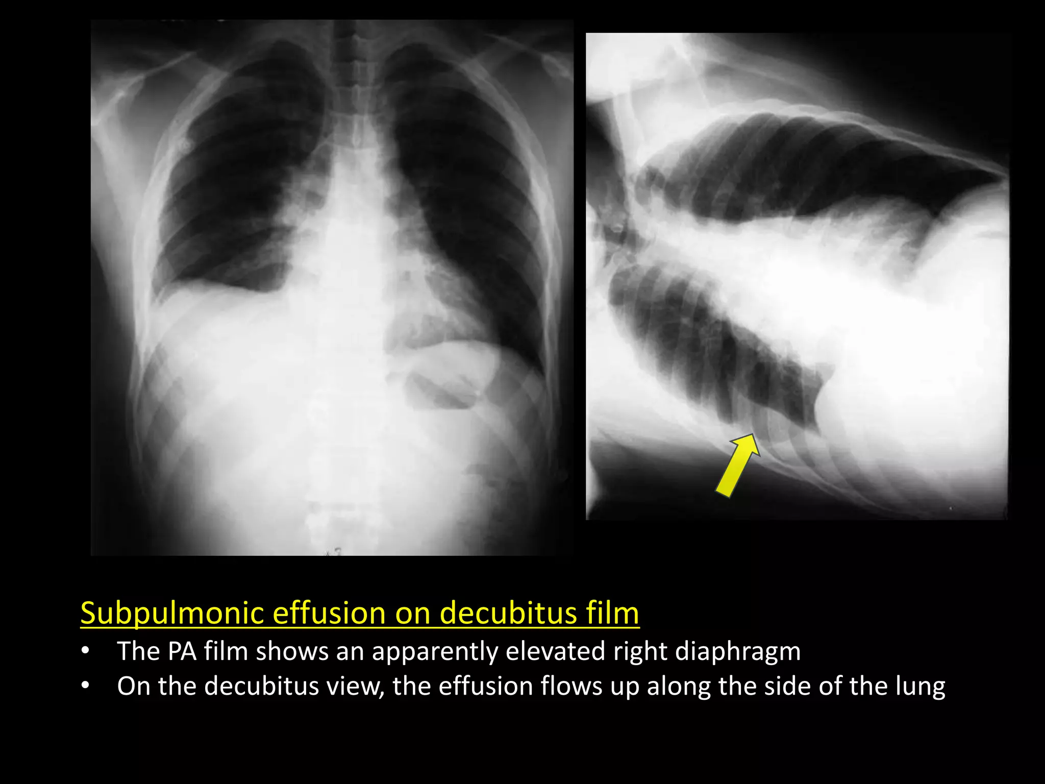 CXR Interpretation for Med Students | PPTX