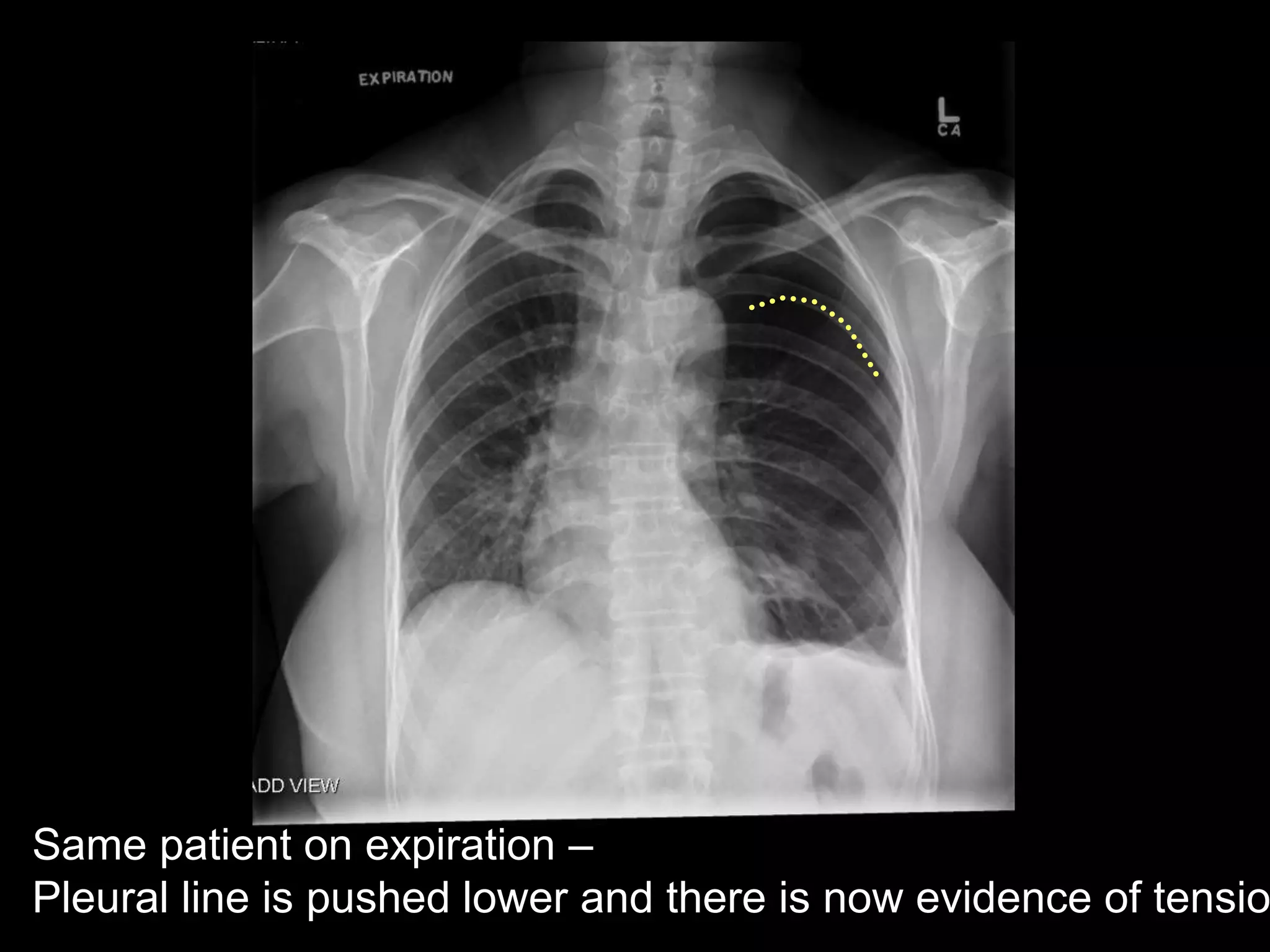 CXR Interpretation for Med Students | PPTX