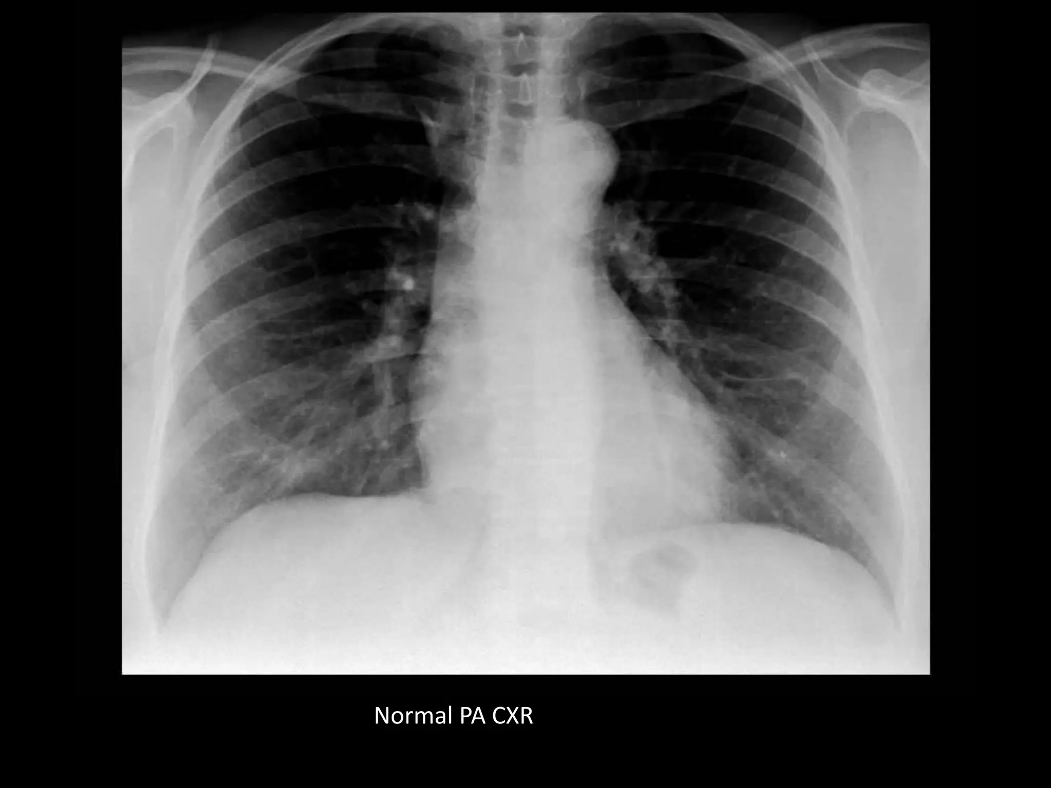 CXR Interpretation for Med Students | PPTX