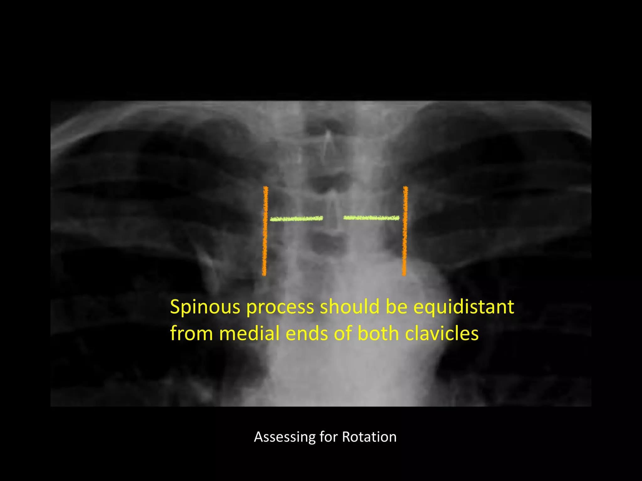 CXR Interpretation for Med Students | PPTX