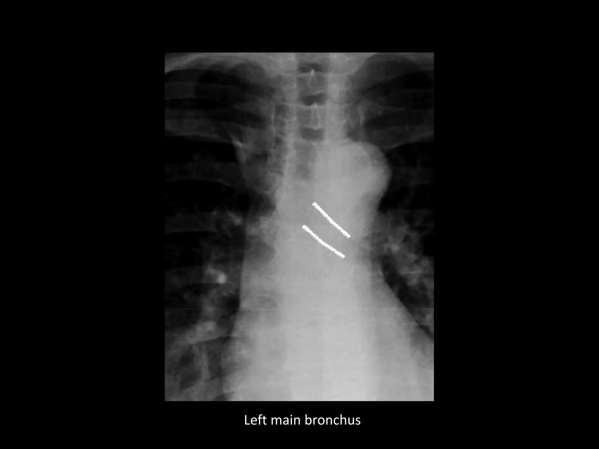CXR Interpretation for Med Students | PPTX