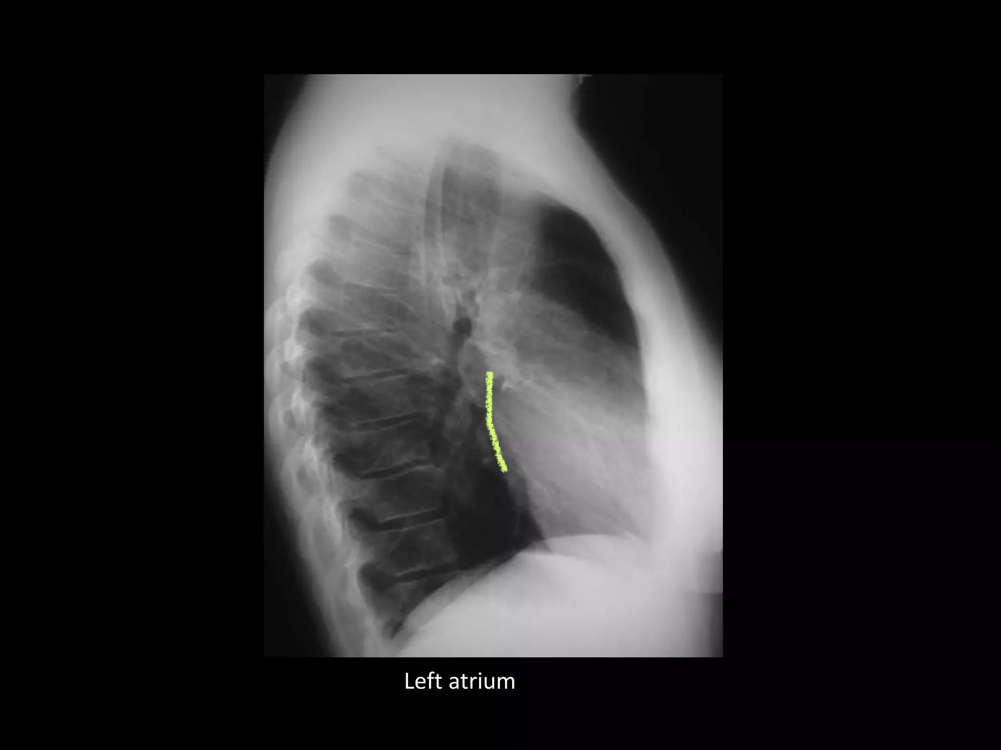 CXR Interpretation for Med Students | PPTX