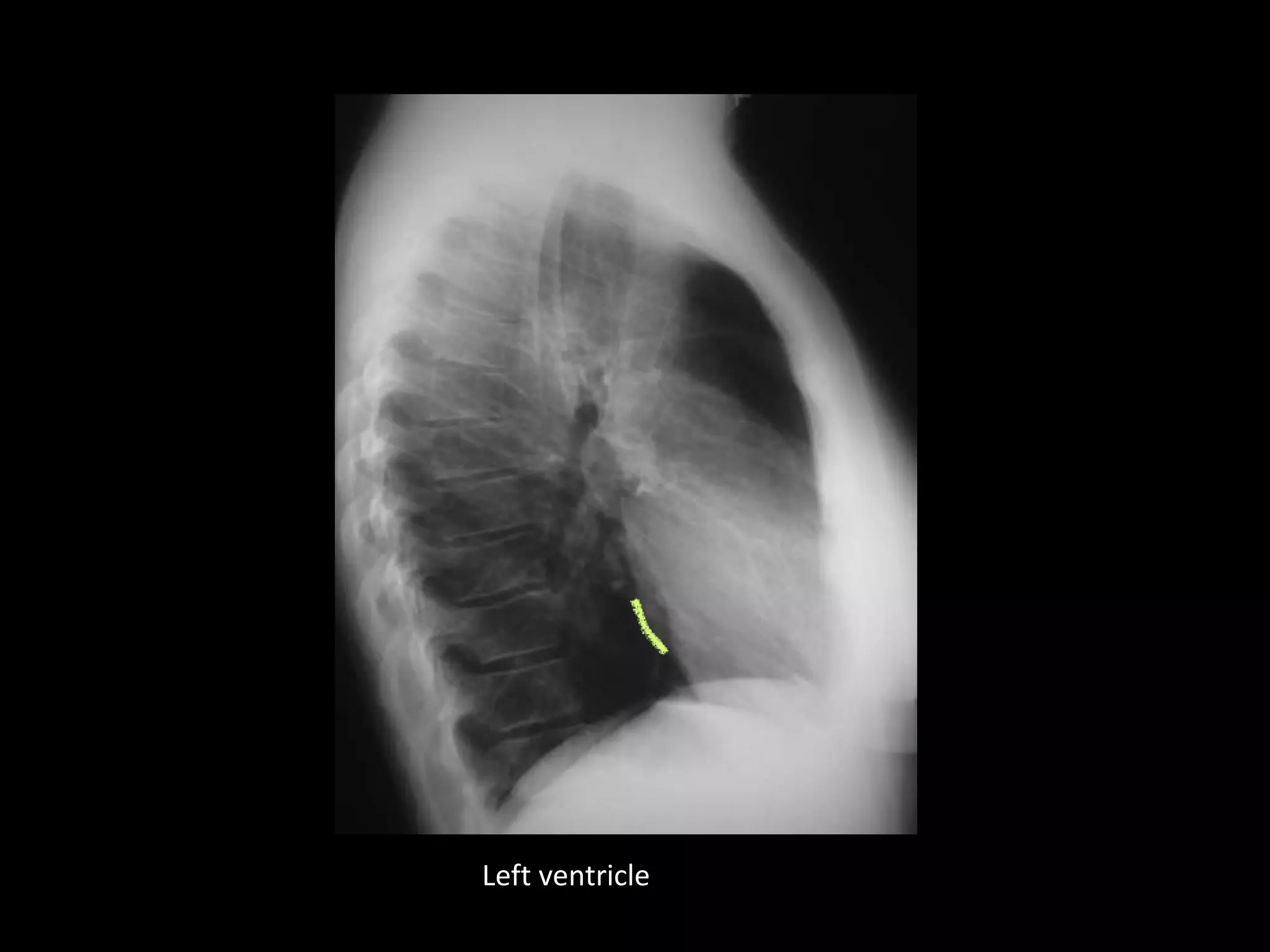 CXR Interpretation for Med Students | PPTX