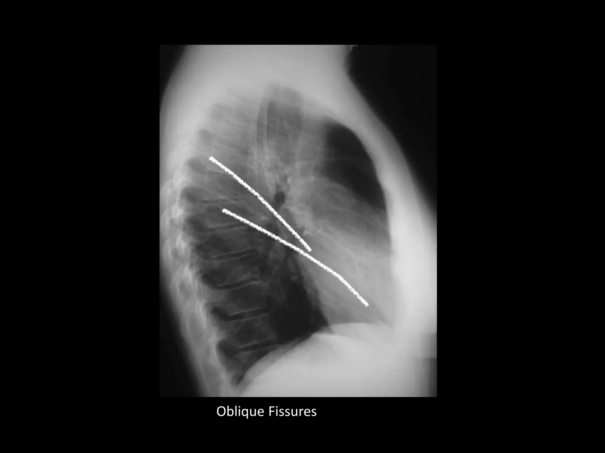 CXR Interpretation for Med Students | PPTX