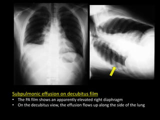 CXR Interpretation for Med Students | PPTX