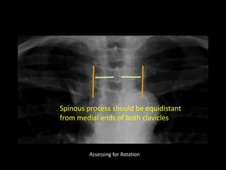 CXR Interpretation for Med Students | PPTX