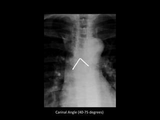 CXR Interpretation for Med Students | PPTX