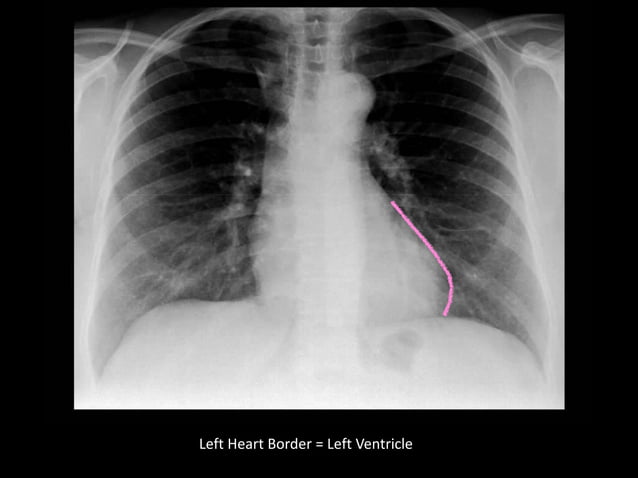 CXR Interpretation for Med Students | PPTX