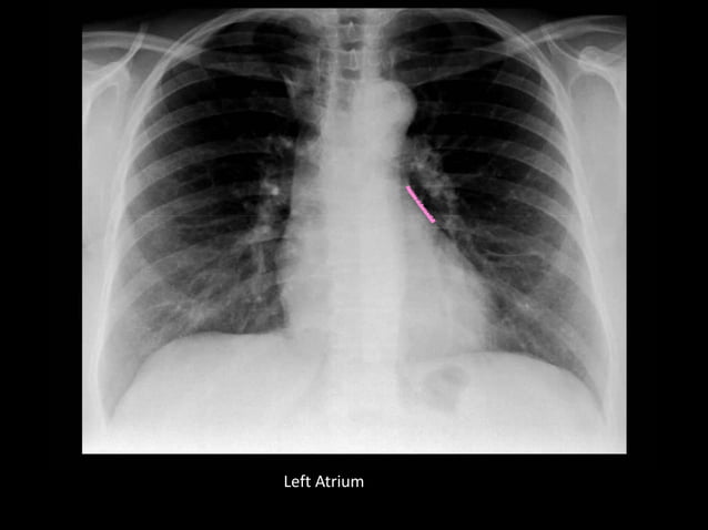 CXR Interpretation for Med Students | PPTX
