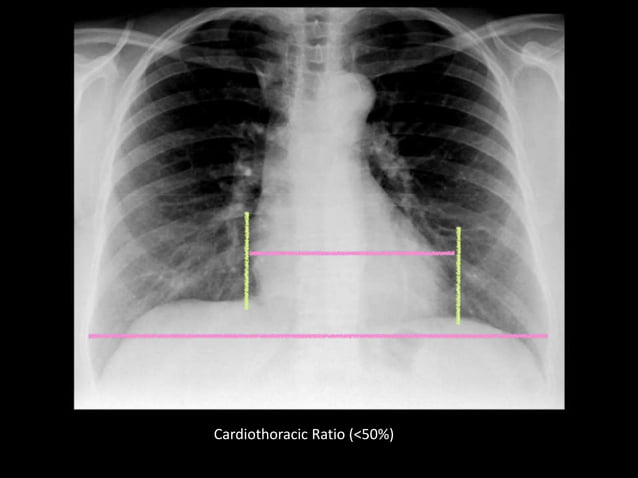 CXR Interpretation for Med Students | PPTX