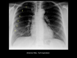 CXR Interpretation for Med Students | PPTX