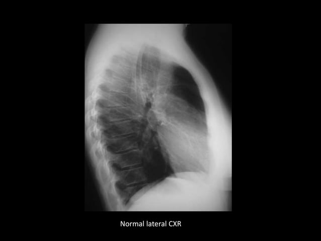 CXR Interpretation for Med Students | PPTX