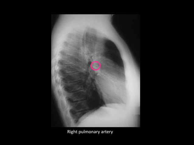 CXR Interpretation for Med Students | PPTX