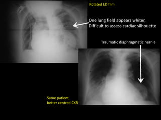 CXR Interpretation for Med Students | PPTX