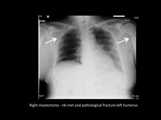 CXR Interpretation for Med Students | PPTX