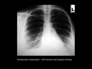 CXR Interpretation for Med Students | PPTX