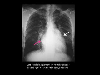 CXR Interpretation for Med Students | PPTX