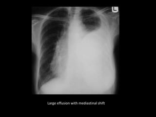 CXR Interpretation for Med Students | PPTX