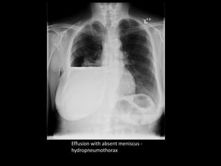 CXR Interpretation for Med Students | PPTX