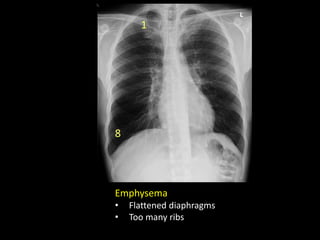 CXR Interpretation for Med Students | PPTX