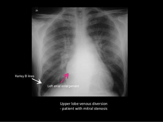 CXR Interpretation for Med Students