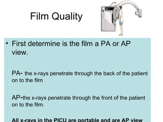 Chest x ray | PPT | Lung and Respiratory Health | Diseases and Conditions
