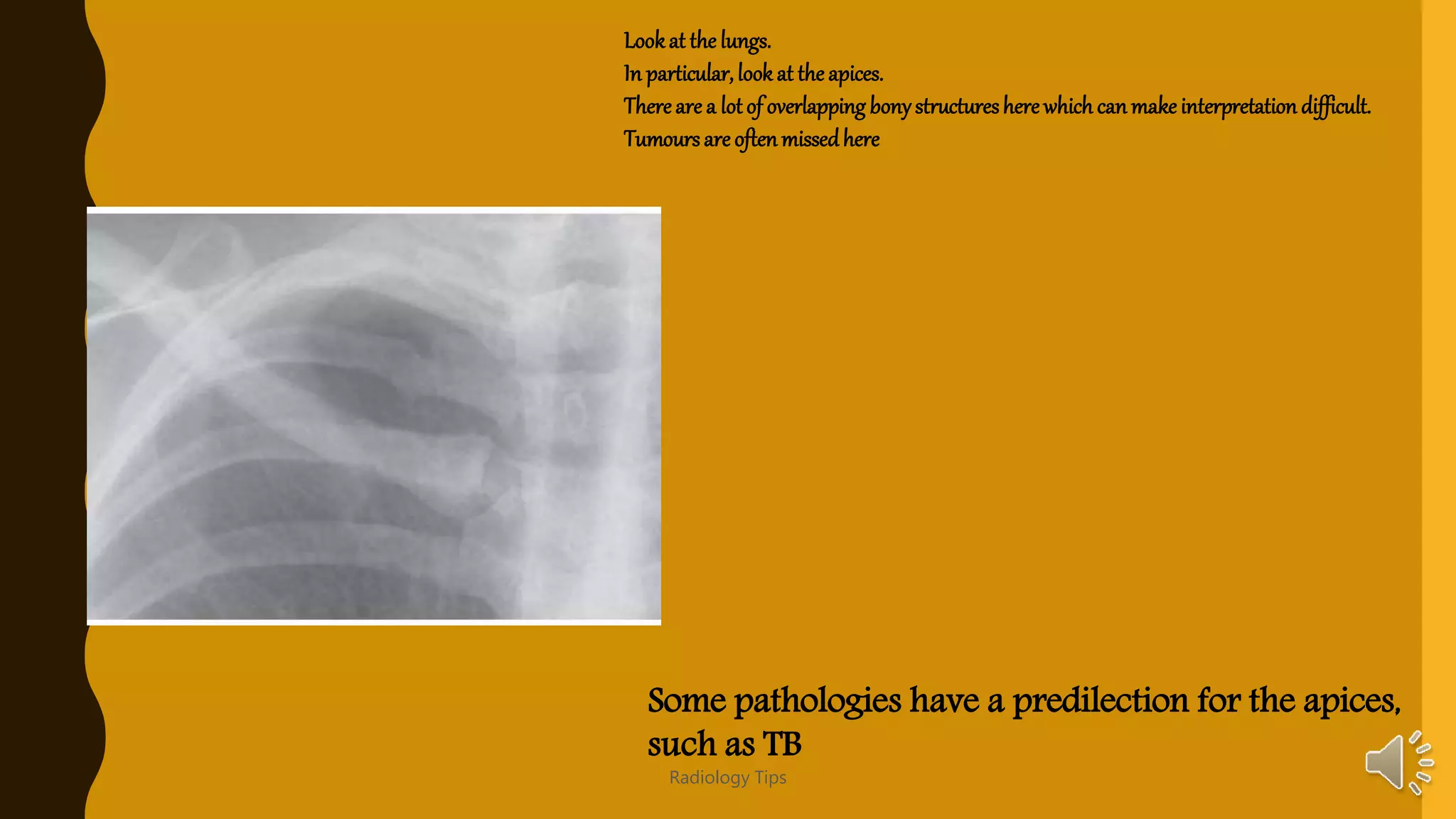 Chest X ray ( steps for interpretation) | PPTX