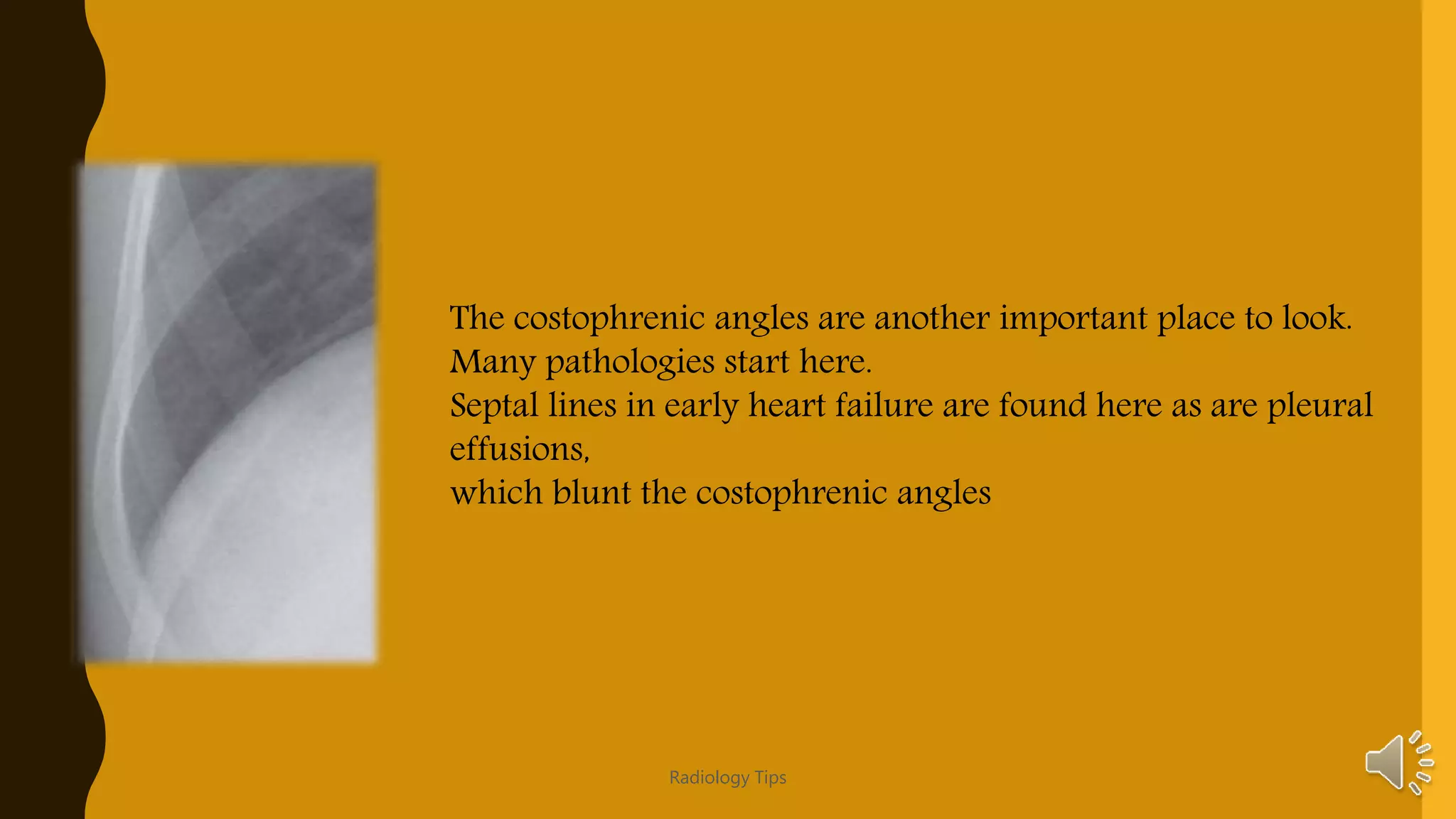 Chest X ray ( steps for interpretation) | PPTX