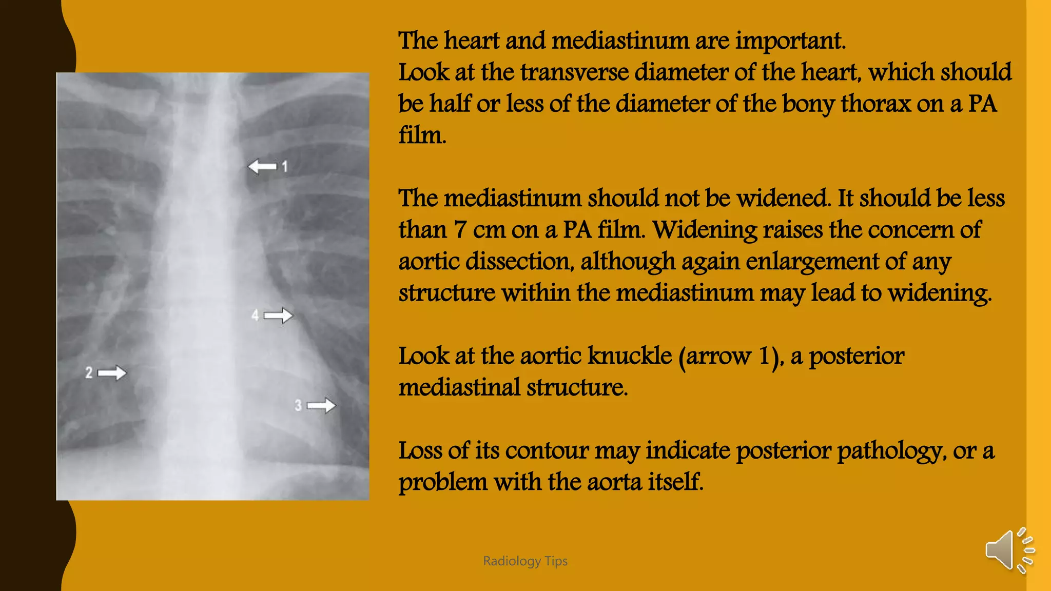 Chest X ray ( steps for interpretation) | PPTX