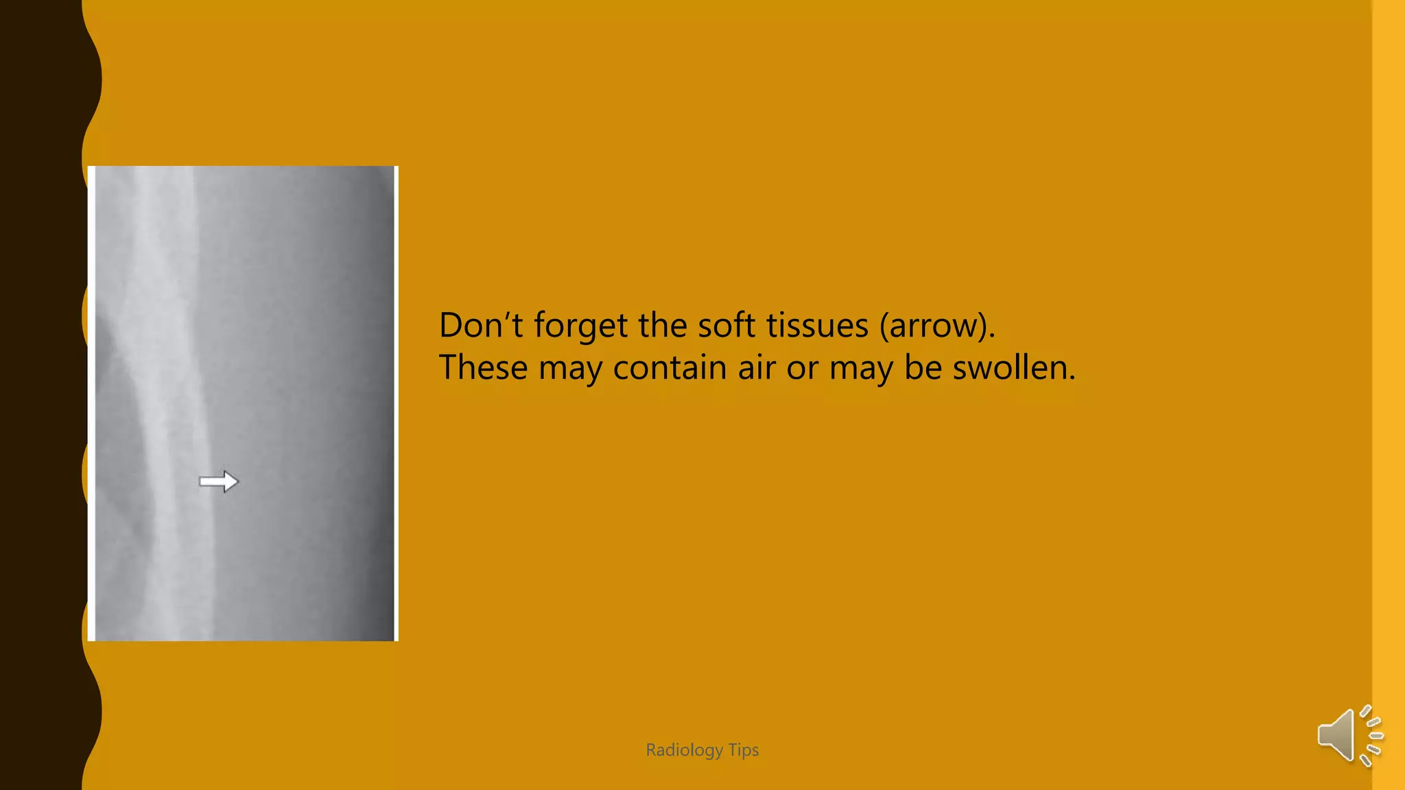 Chest X ray ( steps for interpretation) | PPTX