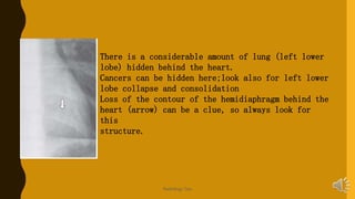 Chest X ray ( steps for interpretation) | PPTX