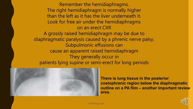 Chest X ray ( steps for interpretation) | PPTX | Lung and Respiratory ...