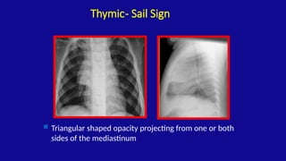 Chest xray - overview on mechanism of xray.pptx