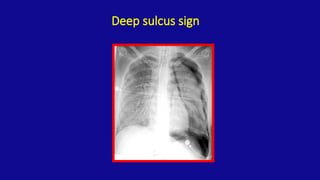 Chest xray - overview on mechanism of xray.pptx
