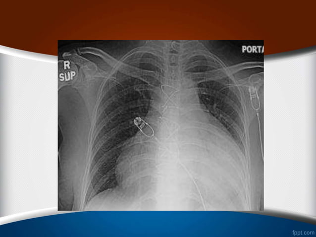 CXR - new.ppt