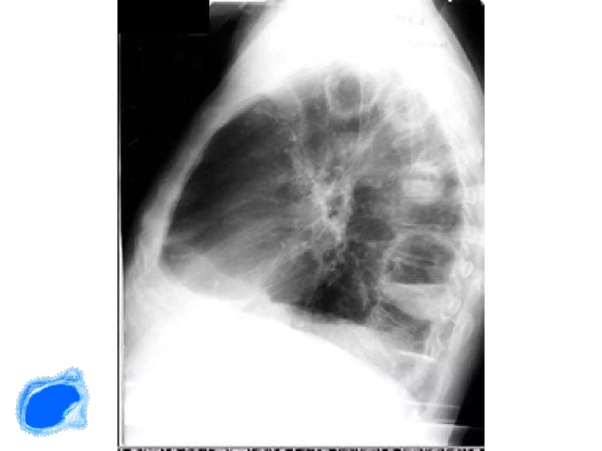 CXR - Cavity in Lung | PPT