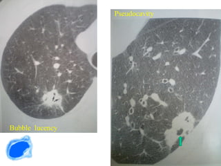 CXR - Cavity in Lung | PPT